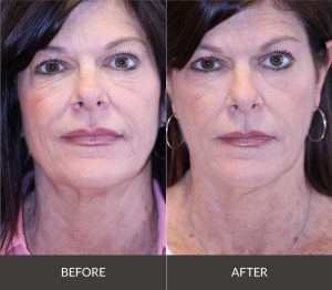 Sofwave™ Skin Tightening in Baton Rouge – Weiler Plastic Surgery Group