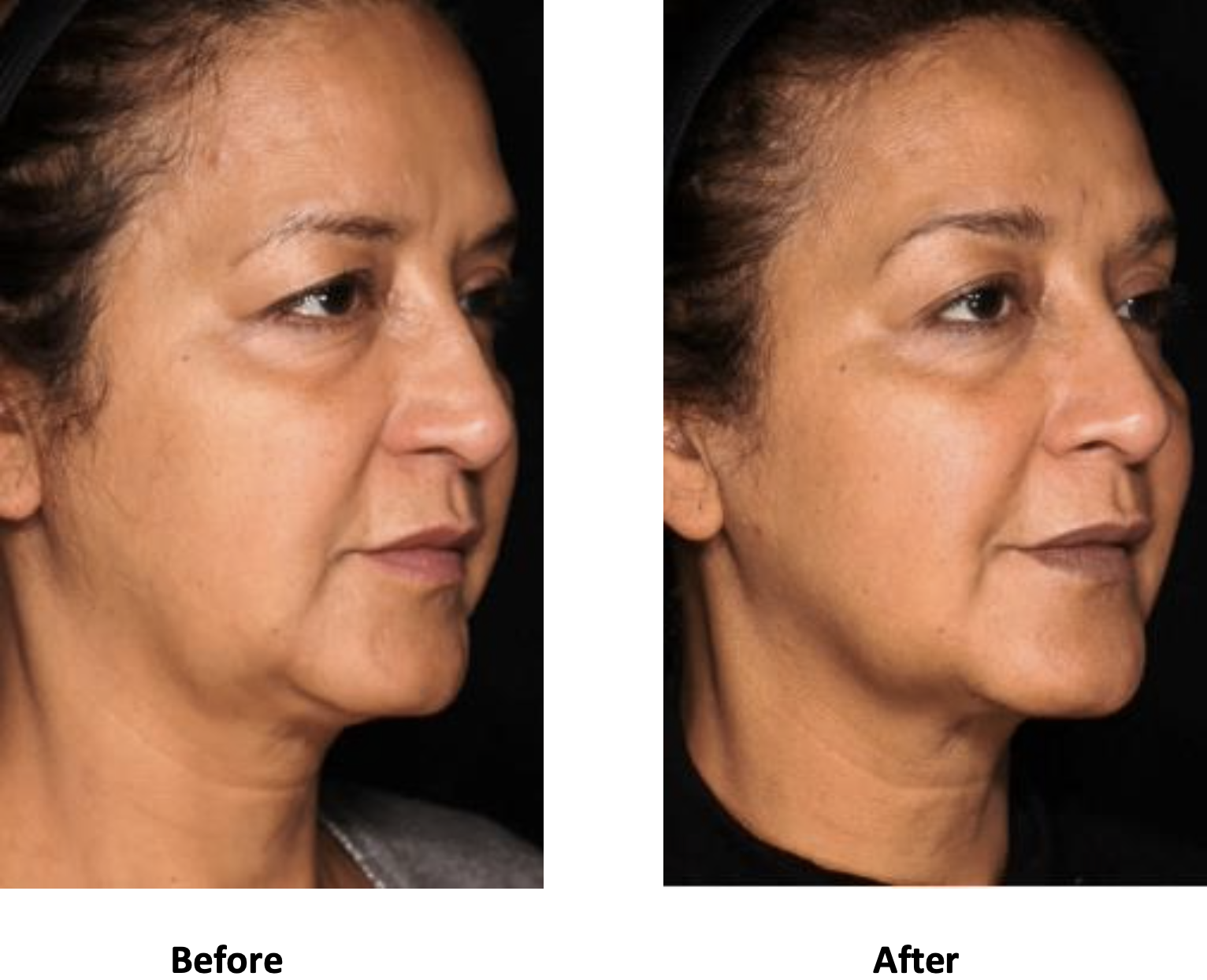 Sofwave™ Skin Tightening for Baton Rouge, New Orleans & Lafayette, LA – Weiler Plastic Surgery Group