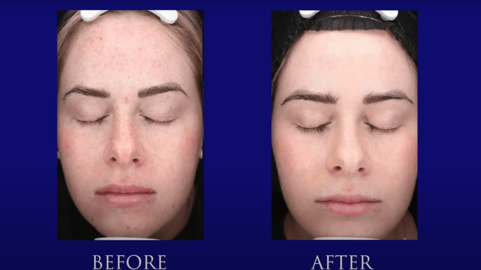 IPL Photorejuvenation 101 – Weiler Plastic Surgery Group